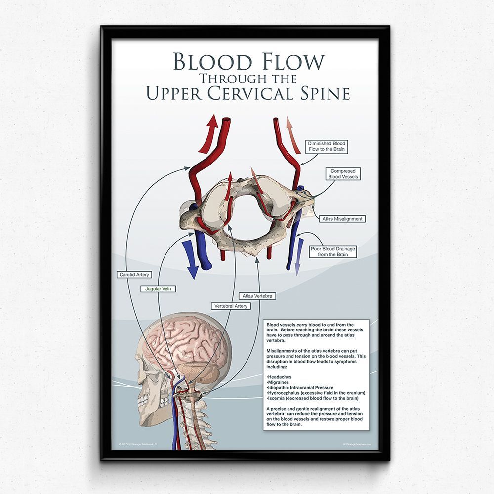 Upper Cervical Posters