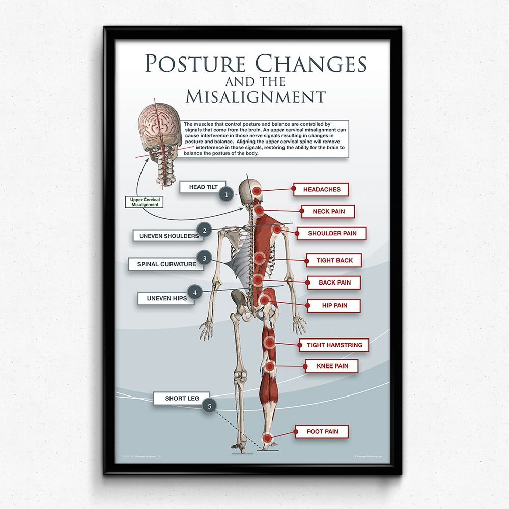 Upper Cervical Posters