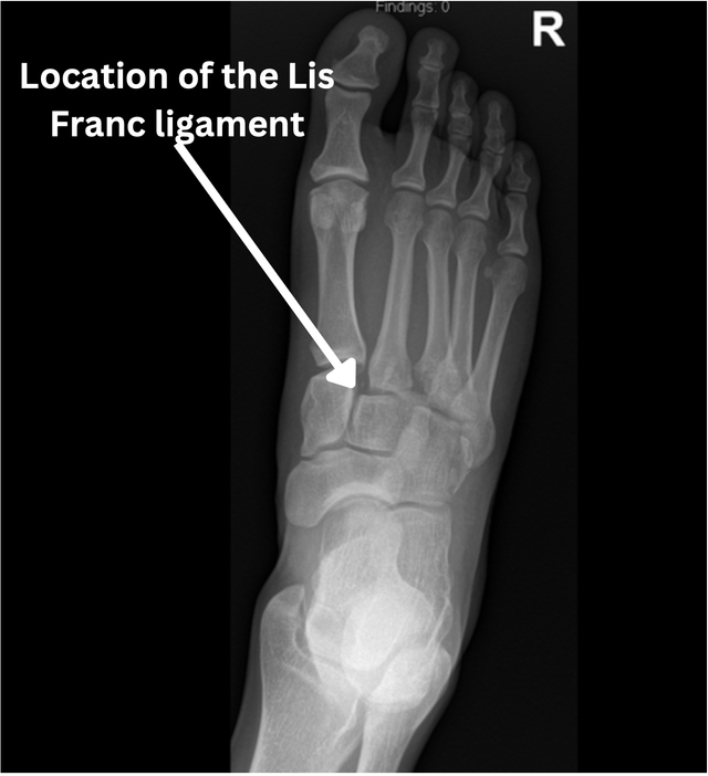 Lisfranc Joint Anatomy LISFRANC (MIDFOOT) FRACTURE – Dr Bishnu Pada
