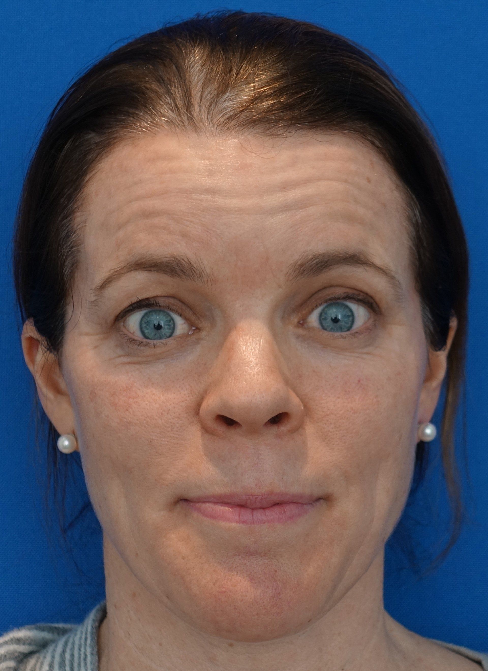Botox Gallery - Chandler Plastic Surgery