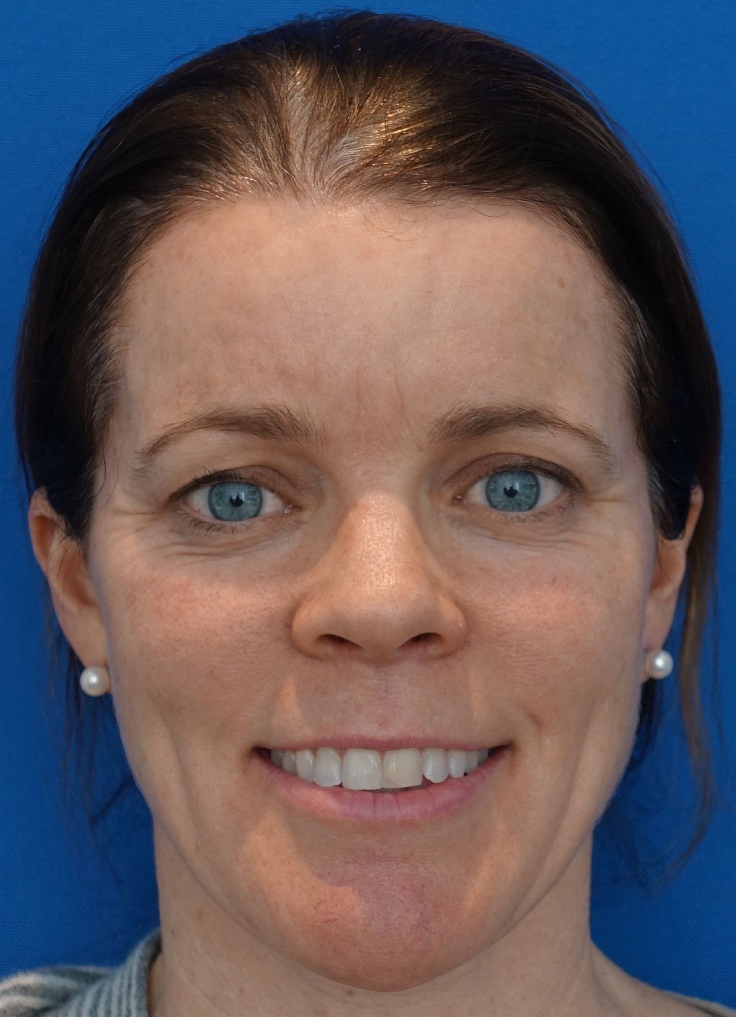 Botox Treatment Darien, CT - Chandler Plastic Surgery