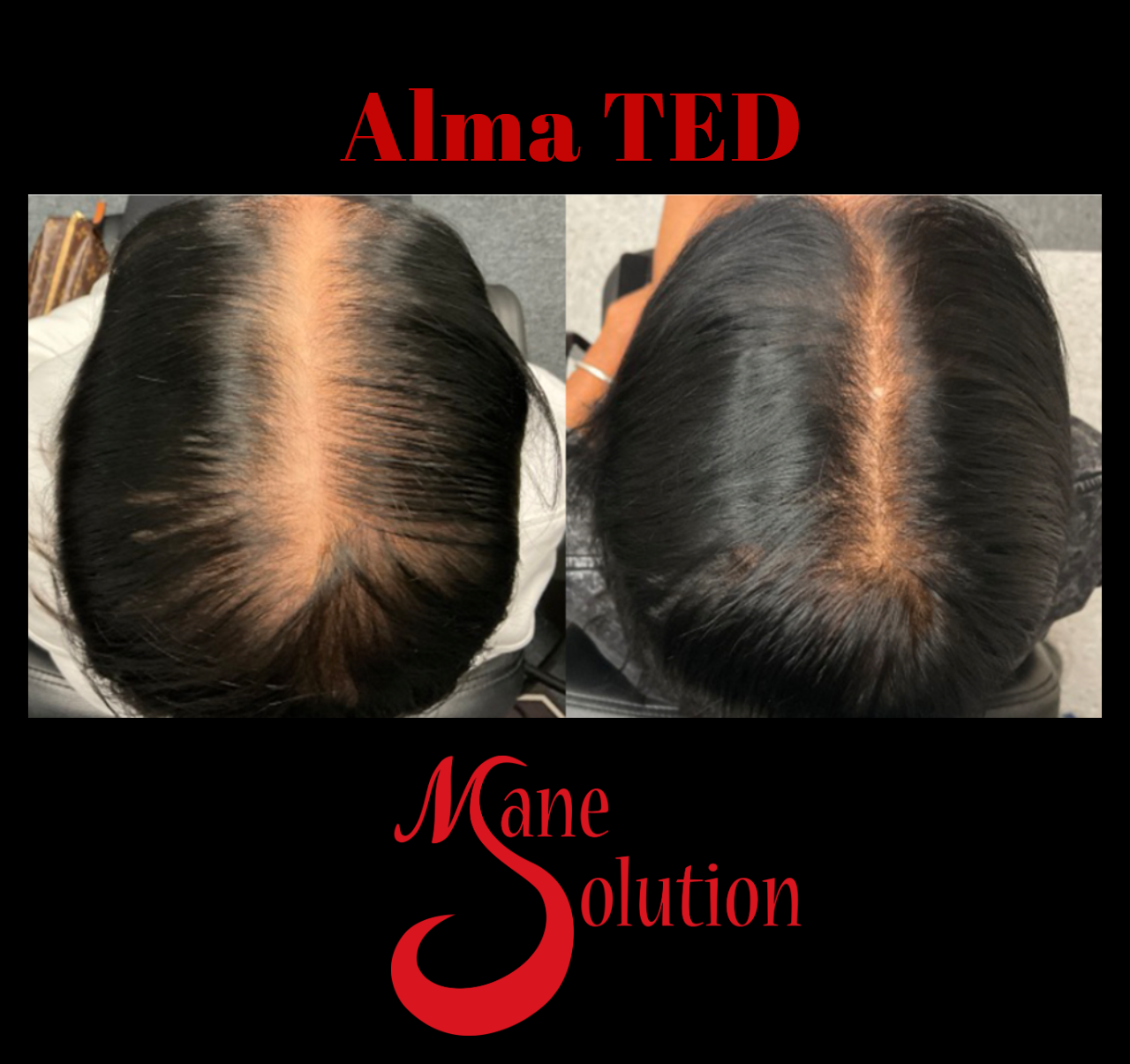 Hair Replacement & Hair Loss Treatment: Latham, NY | Mane Solution