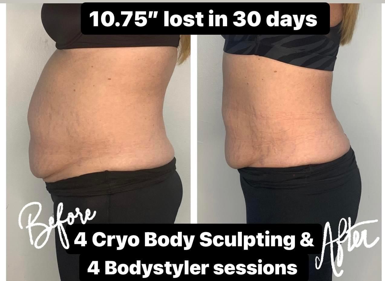 Before & After | FrostFit Cryo | Cryotherapy