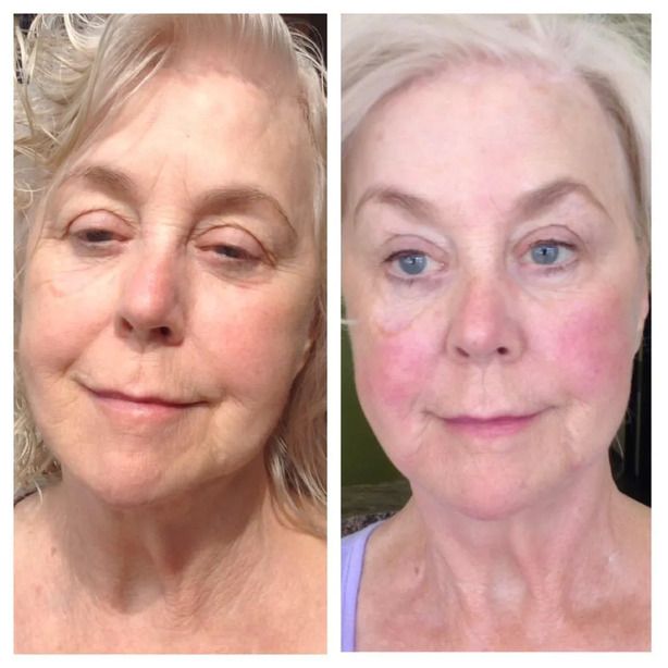 Facial Treatments In Carmel IN By Body Lyft System