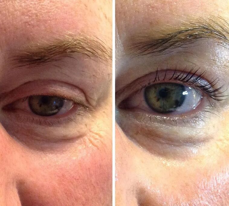 Facial Treatments In Carmel IN By Body Lyft System