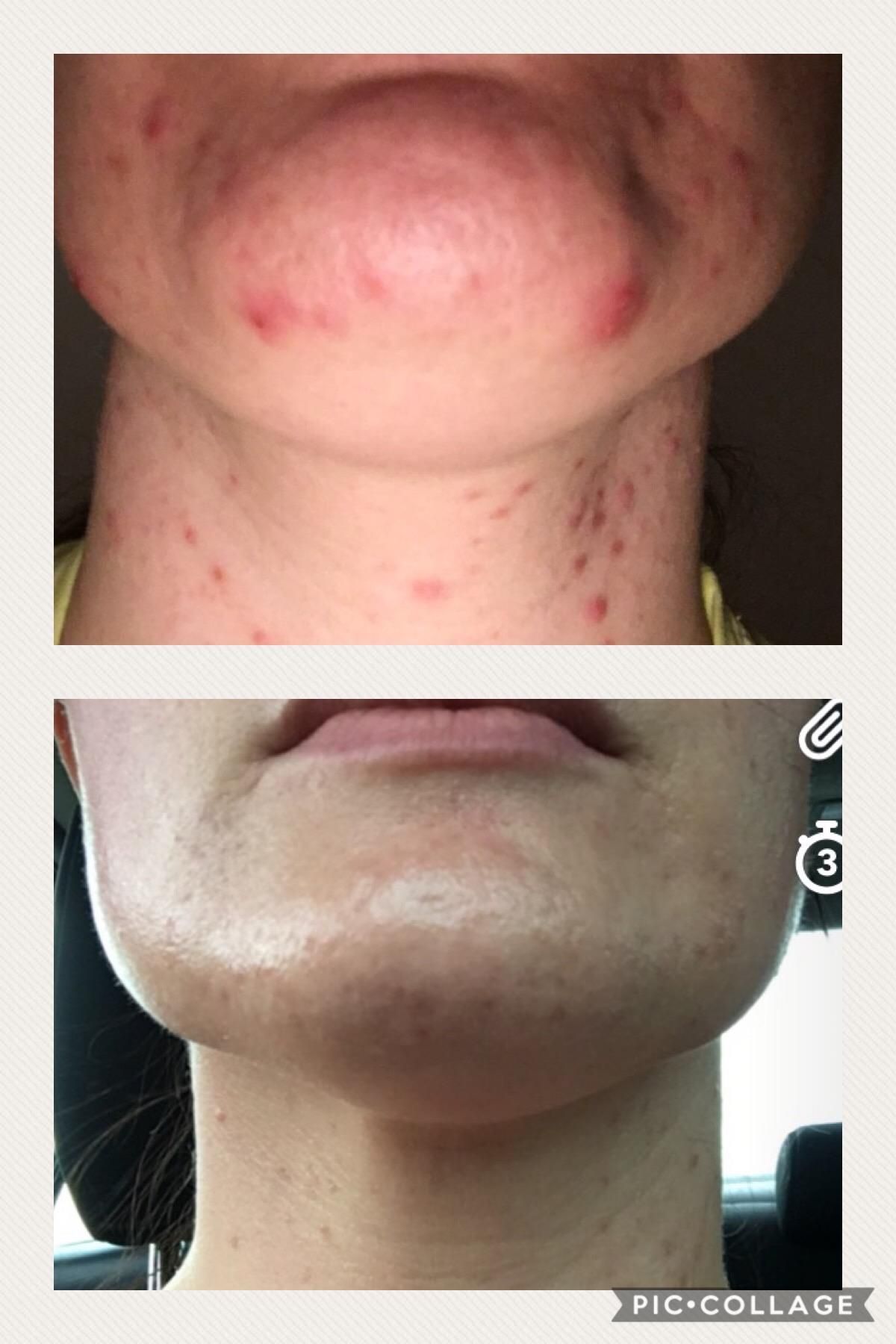 Facial Treatments In Carmel IN By Body Lyft System