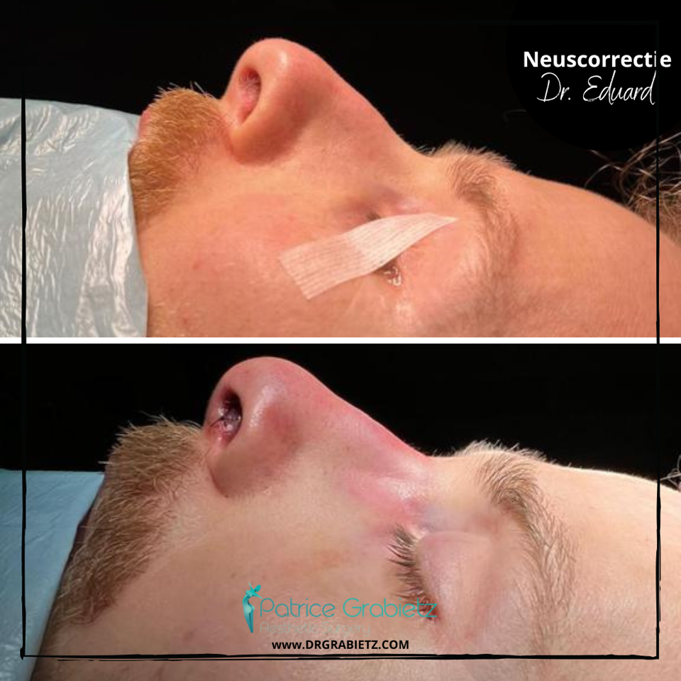 Neuscorrectie Operatie Procedure Neus Fillers Vanaf €410 | Face Your