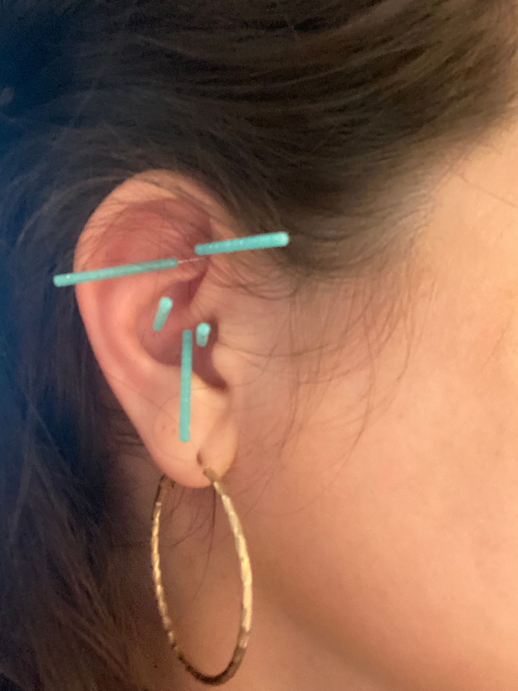Ear Acupuncture | Grounded Path Holistic Counseling LLC