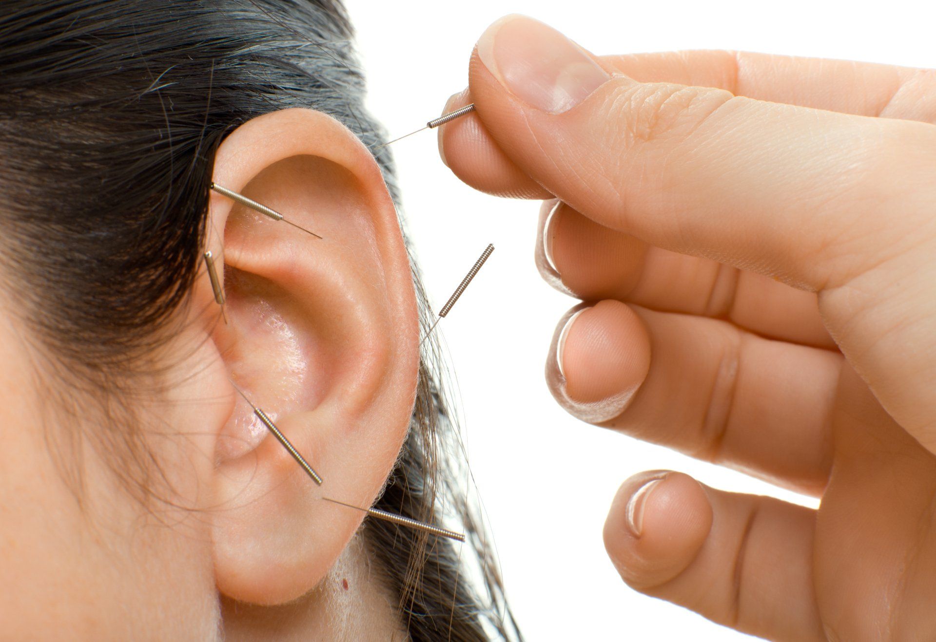 EAR ACUPUNCTURE (5NP)