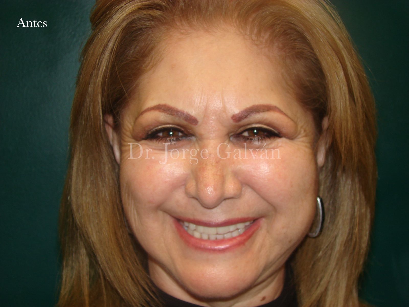 Cirugia Plastica Chihuahua | Dr. Jorge Galvan | Cirujano Plastico