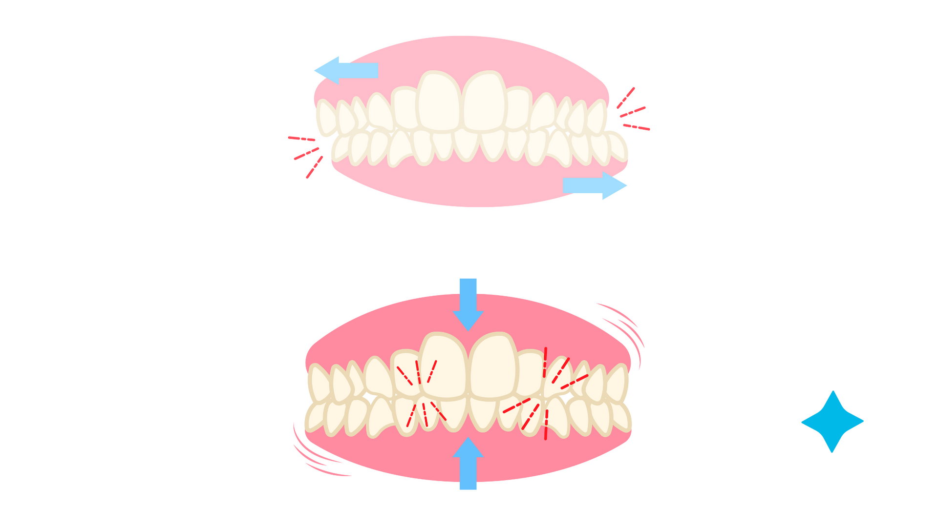 Unlocking Comfort: The Definitive Guide to TMJ Relief with Metal Braces