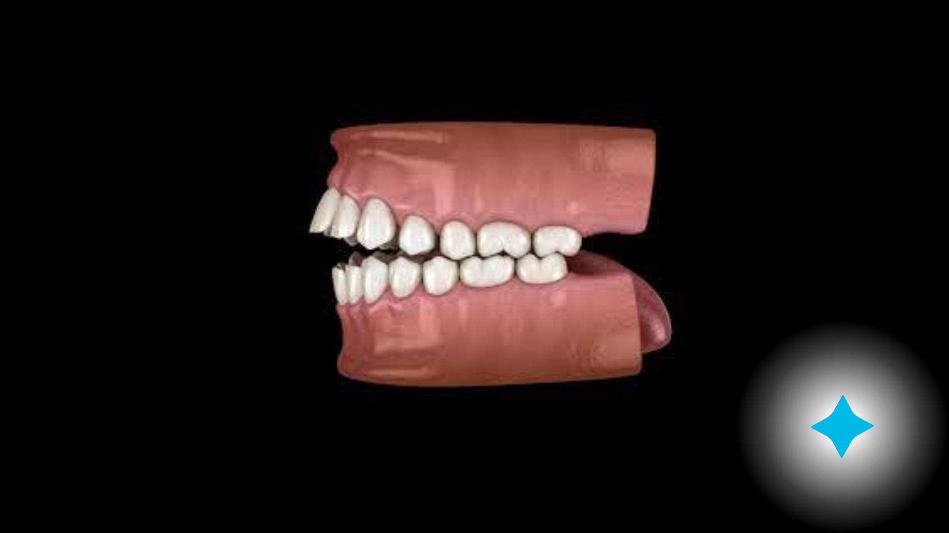 Understanding and Treating Open Bite with Metal Braces