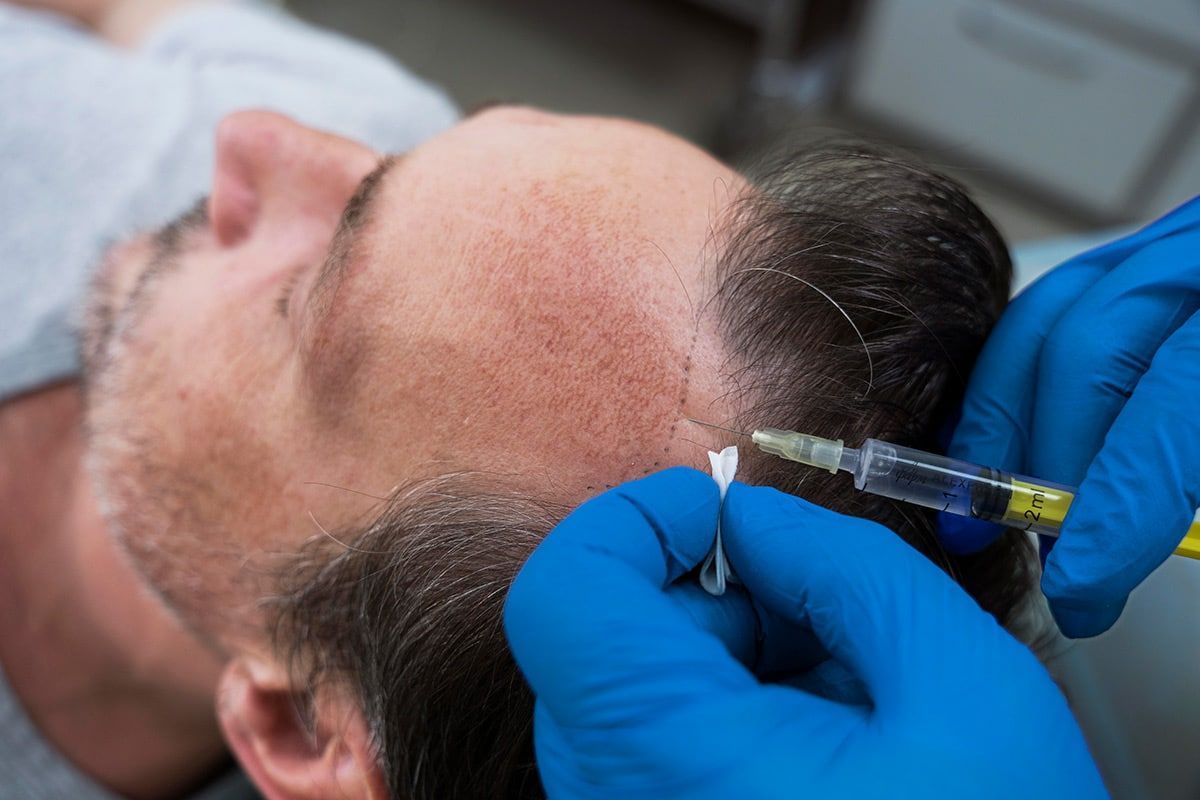 Scalp Micropigmentation Aftercare: What You Need to Know