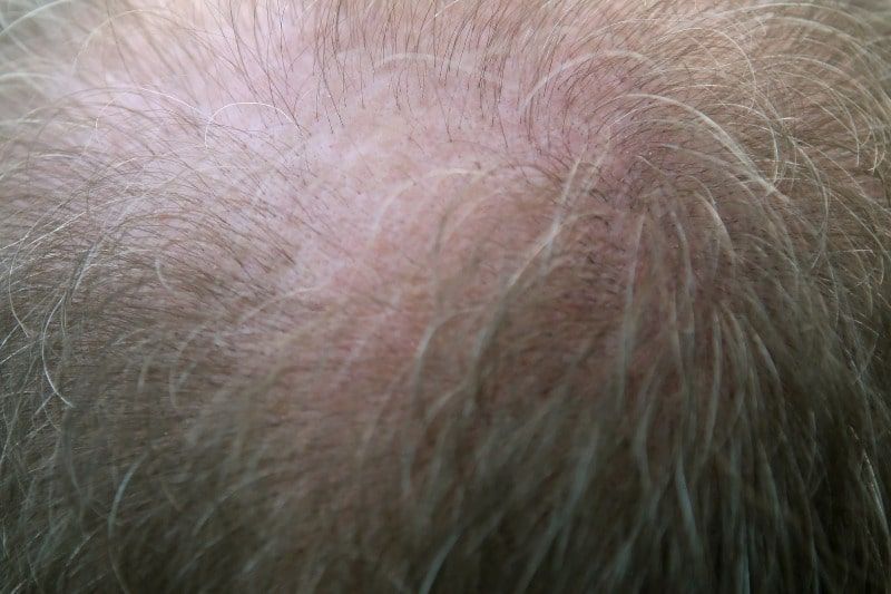 Scalp Micropigmentation and Grey Hair: How Does it Work?