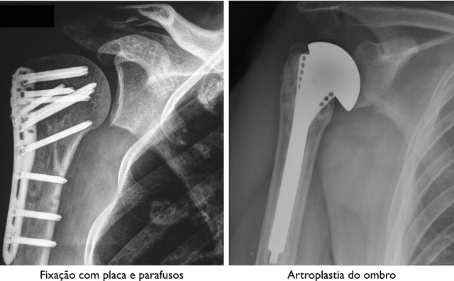 Fixacao De Fratura De Olecrano A. Fratura Completa Das Diáfises Do