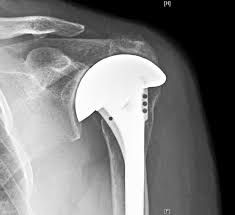 Orthopaedic Technology | Canberra, Bega & South NSW | Dr Rajesh