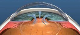 The importance of checking intraocular pressures