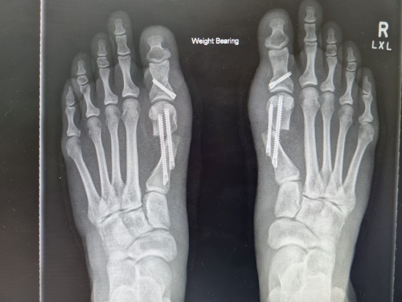 KEYHOLE BUNION SURGERY UPDATE