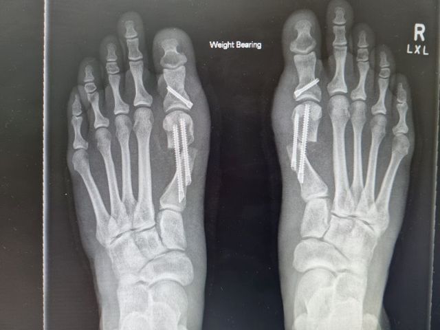 Radiographic Keyhole