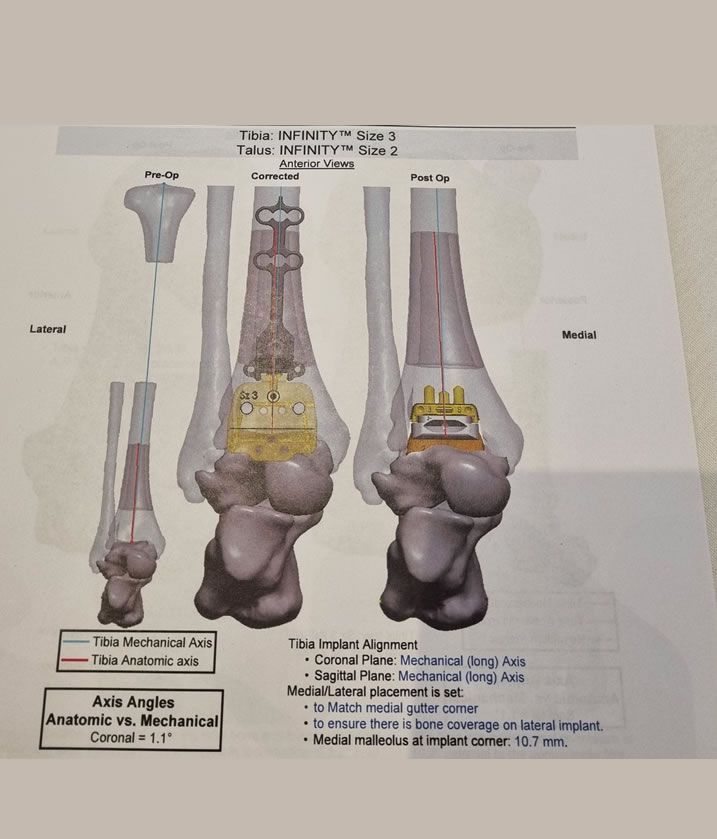 ADVANCES IN TOTAL ANKLE REPLACEMENTS