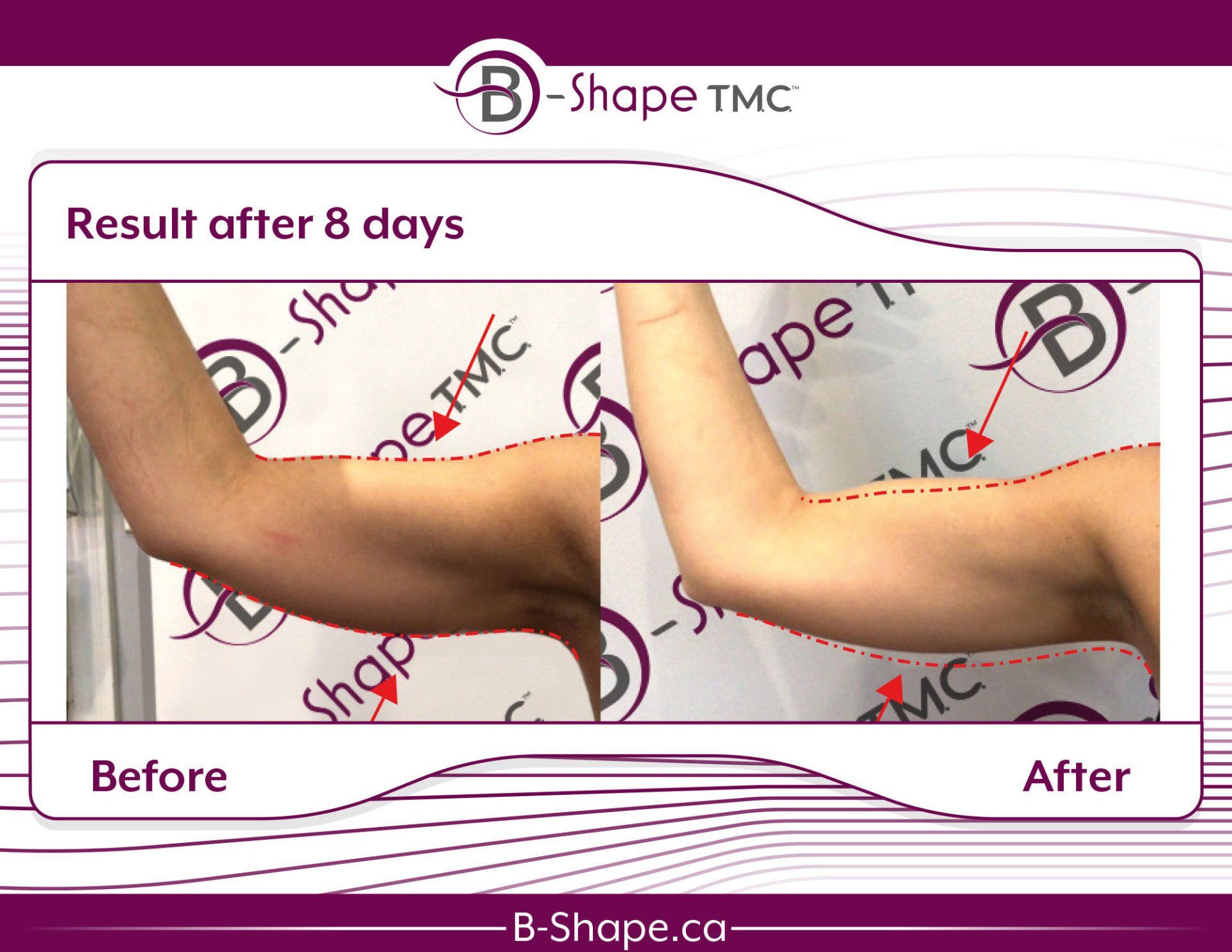 Treatment for Fat Reduction & Body Contouring Ottawa | B-Shape T.M.C.