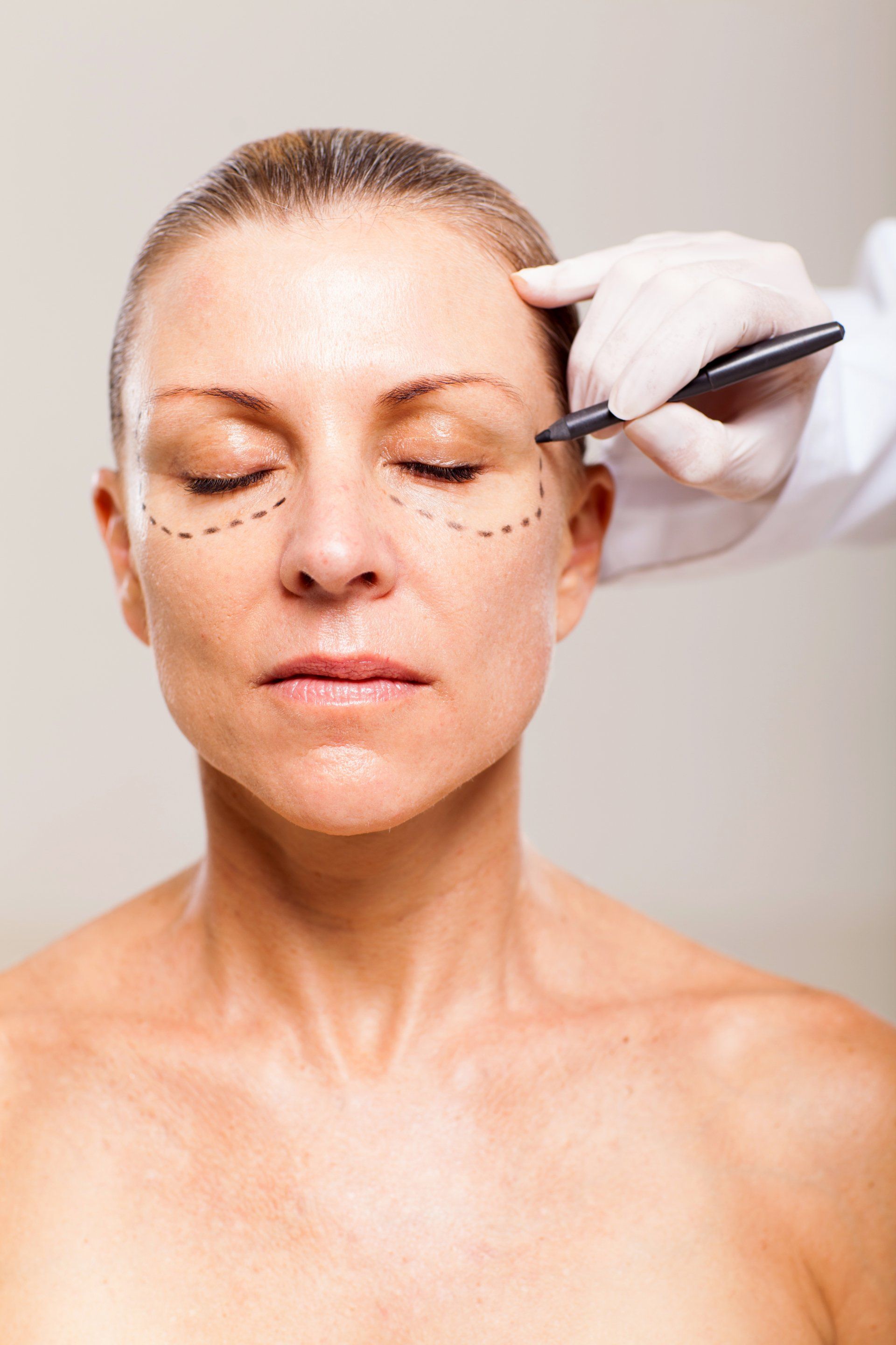 Blefaroplastia: saiba o que é e quais os cuidados necessários