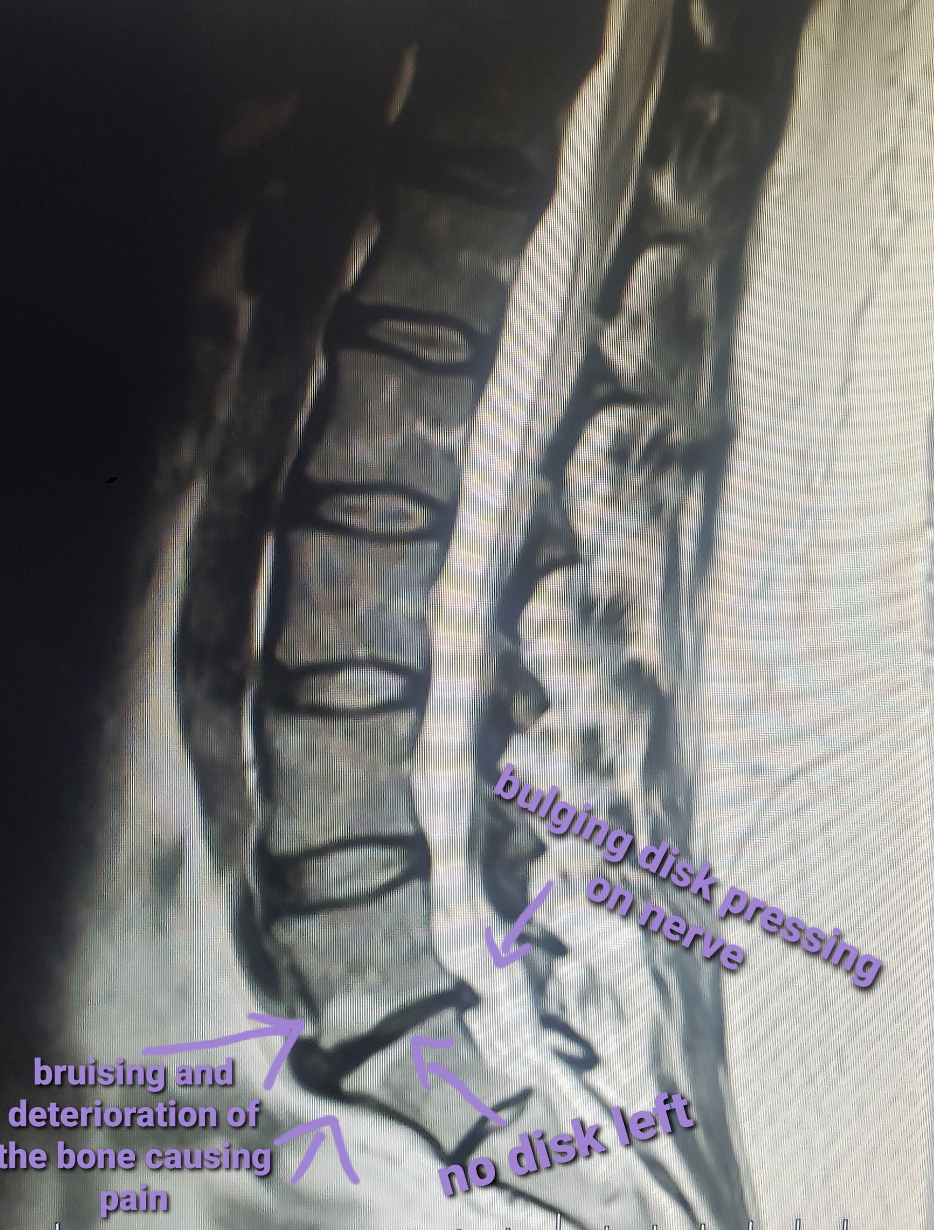 Follow me in My Experience with L5 S1 ALIF Back Surgery