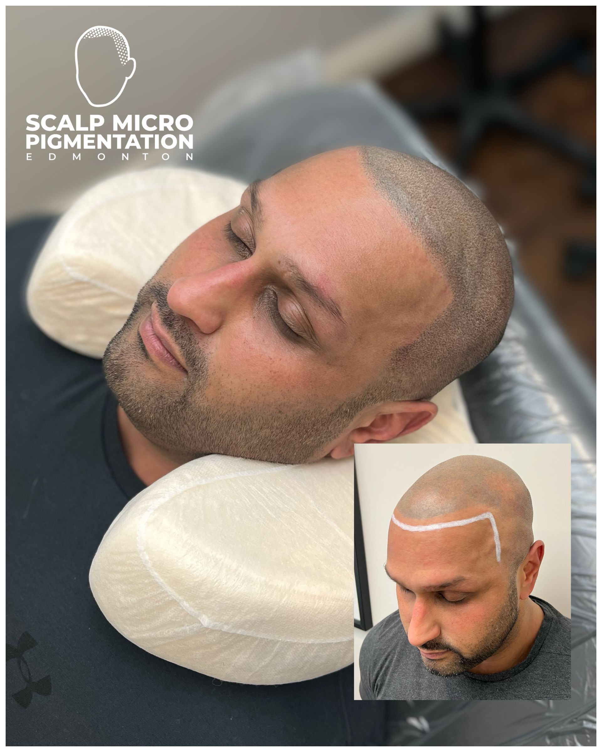 Scalp Micro Pigmentation - Treatments | Overcome Hair Loss