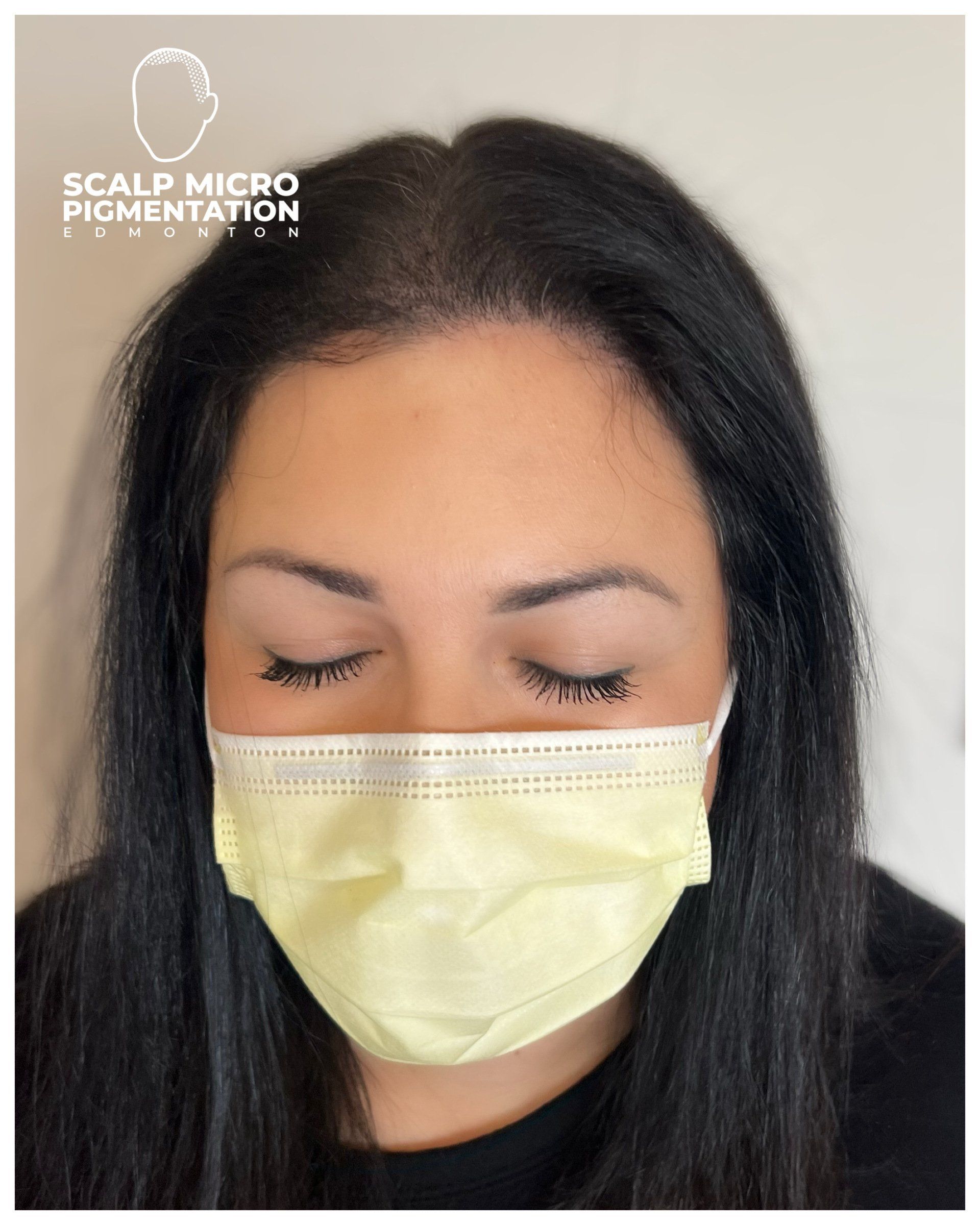 Female Scalp Micropigmentation Client Before & After Results