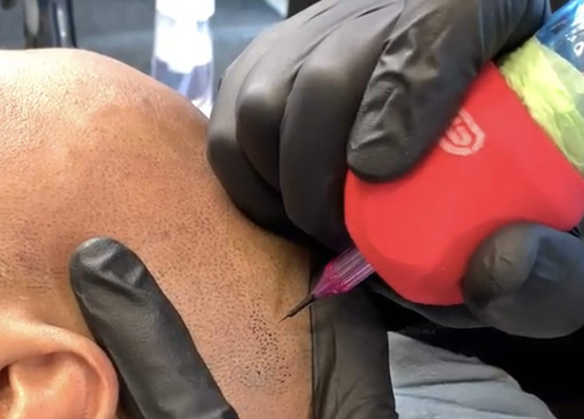 How Scalp Micropigmentation Can Help You Regain Self Confidence