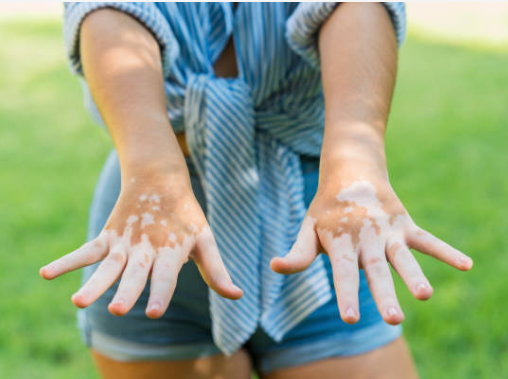 Pediatric Dermatology in Southern California | Advanced Dermatology