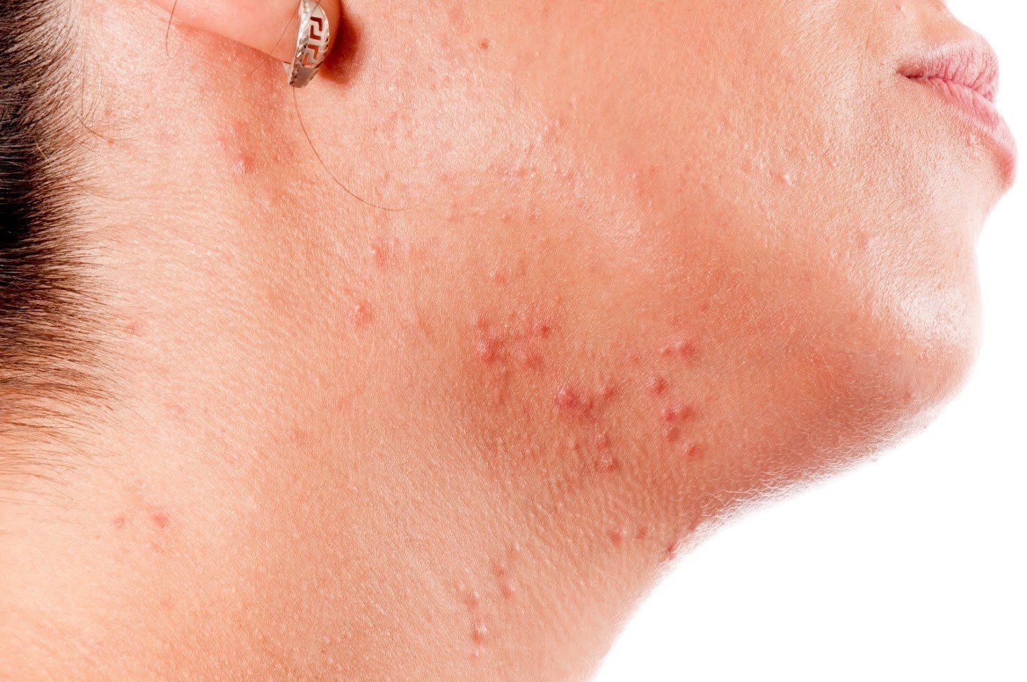 Sz tz z Helyette K lcs nz s Should I Pop A Zit T ny r Szellemes Egy 