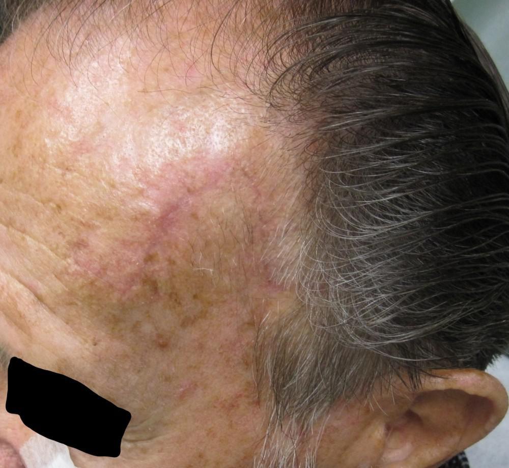 Mohs Micrographic Surgery - Basal Cell Carcinoma On The Temple