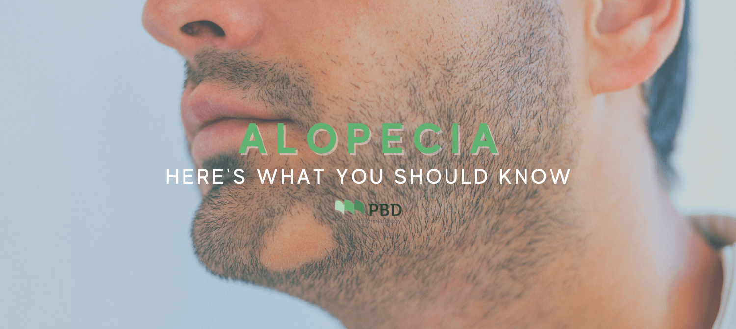 What Is Alopecia: Everything You Need to Know