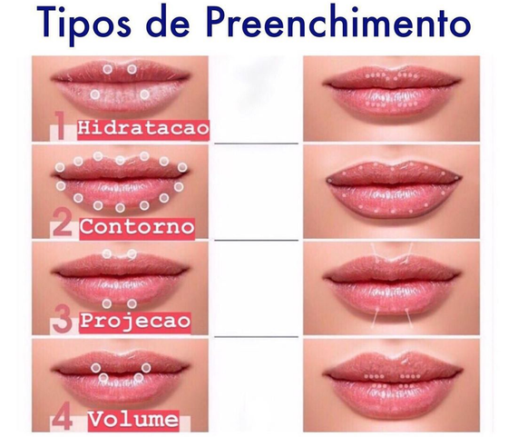 Preenchimento Labial em Fortaleza - saiba TUDO sobre!