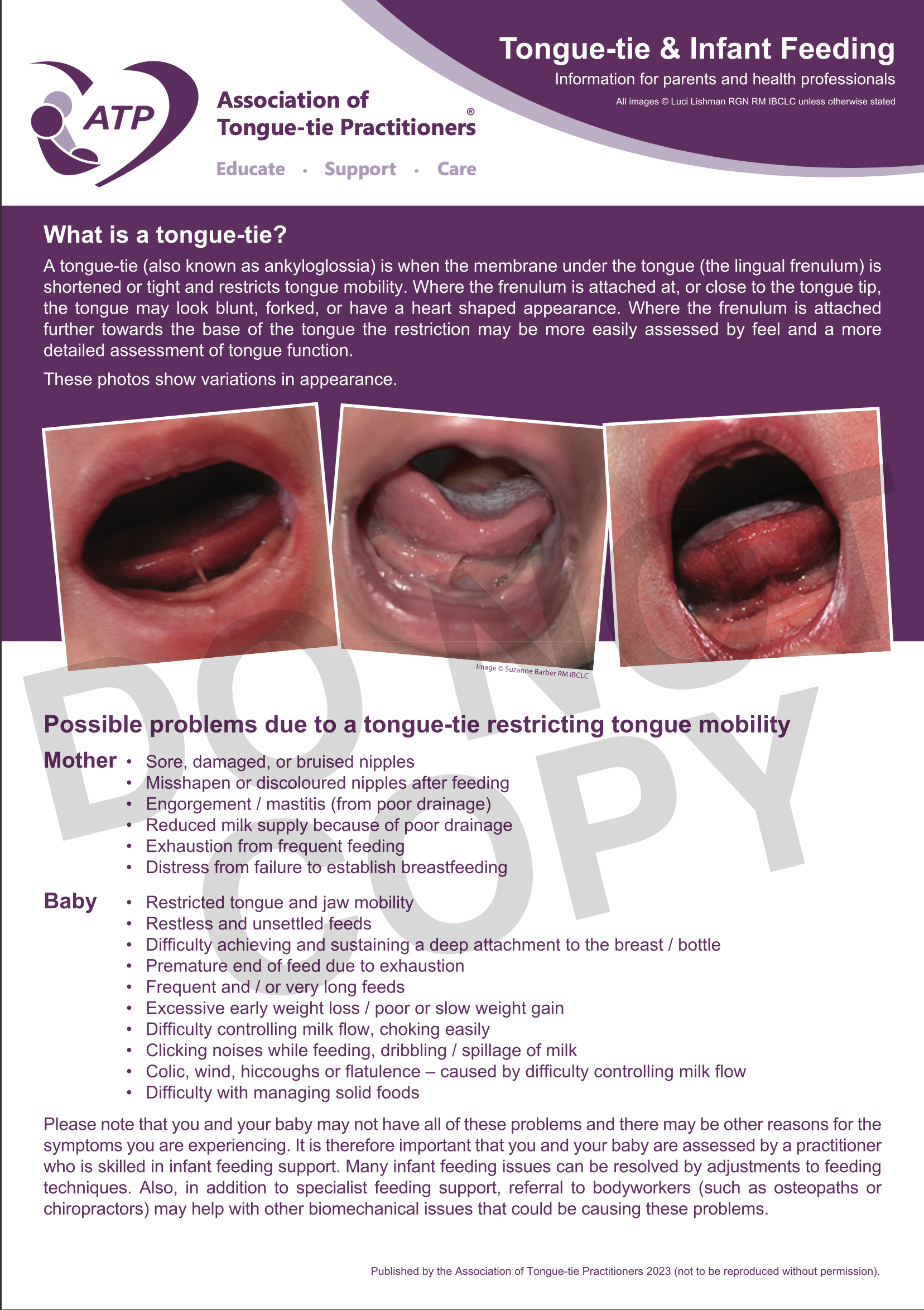 Infant Tongue Tie Tongue Tie Practitioners