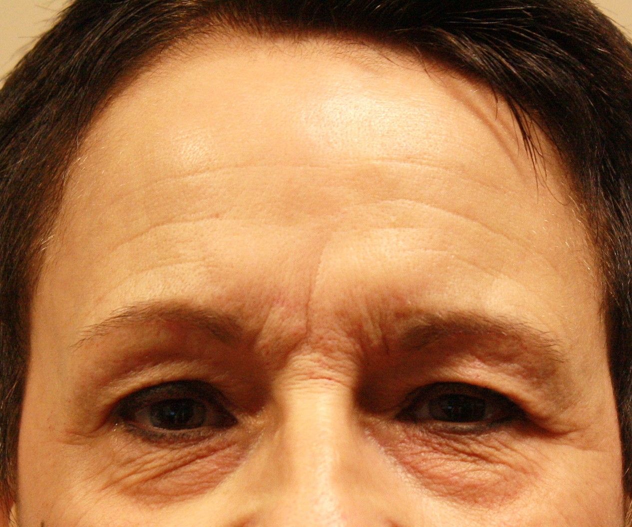 Chirurgie esthétique du front | Clinique O - Chirurgie plastique de l'oeil