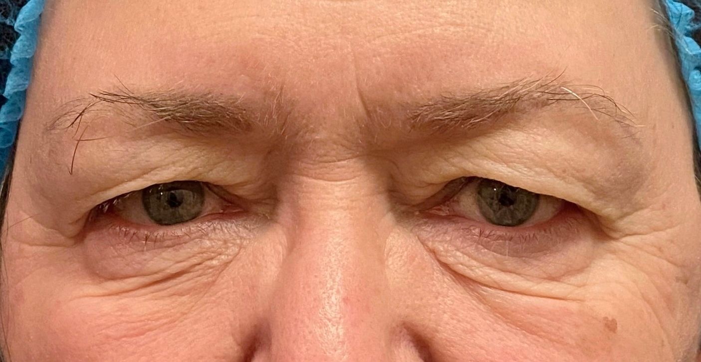 Clinique O | Chirurgie des Paupières Supérieures Avant et Aprés