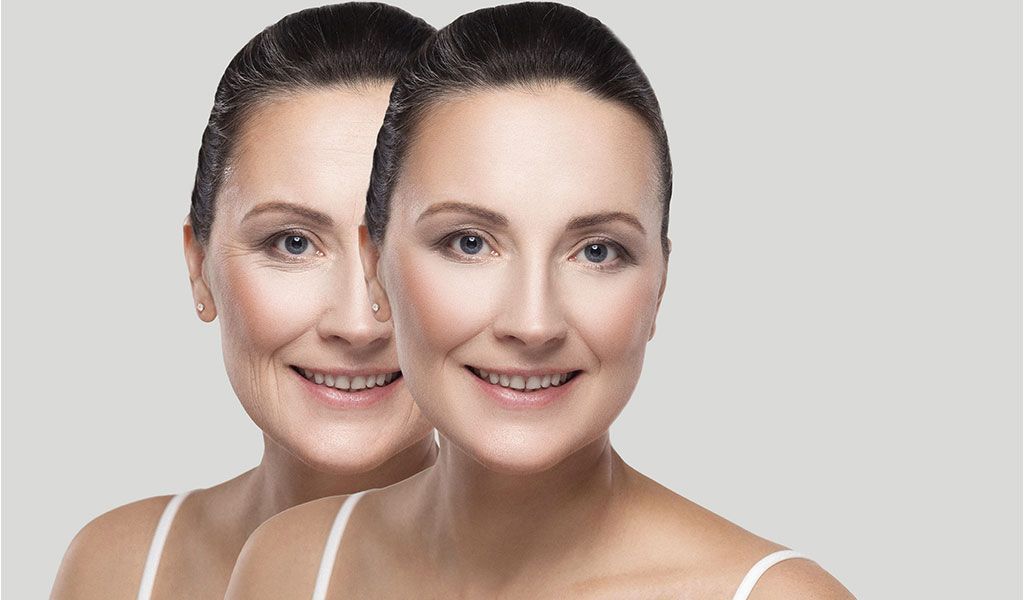 How Long Do the Effects of Double Chin Liposuction Persist?