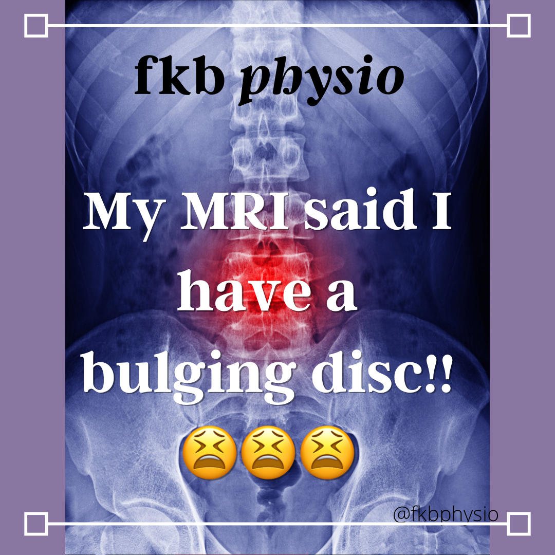 Having a disc bulge is not as scary as you think