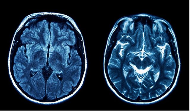 Mri Scan Brain Procedure