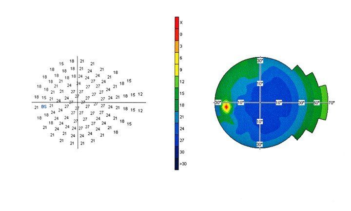 What Is A Visual Field Test 
