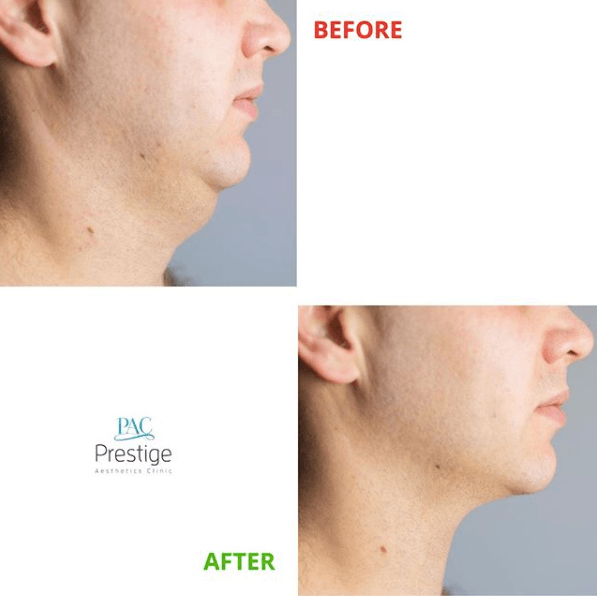 Kybella and Fat Melting Injection | Boca Raton Med SPA