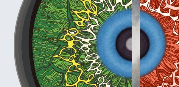 Cataract | Epping Eye Surgery | NSW