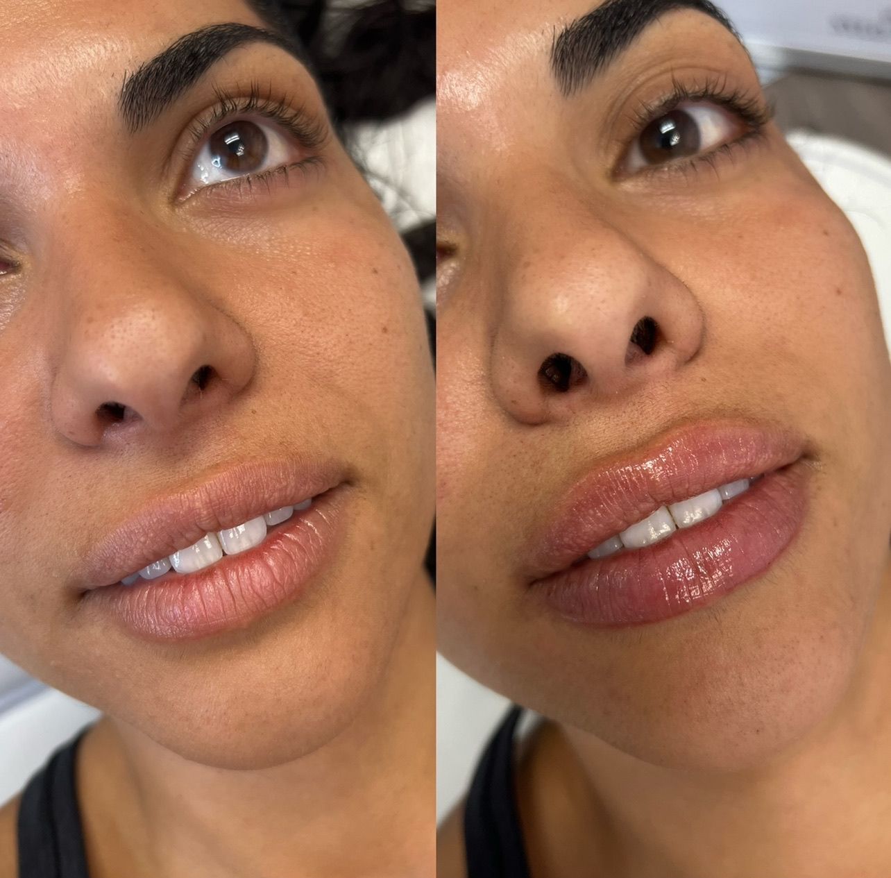 Injectables Lip Filler in Boston and Southborough MA