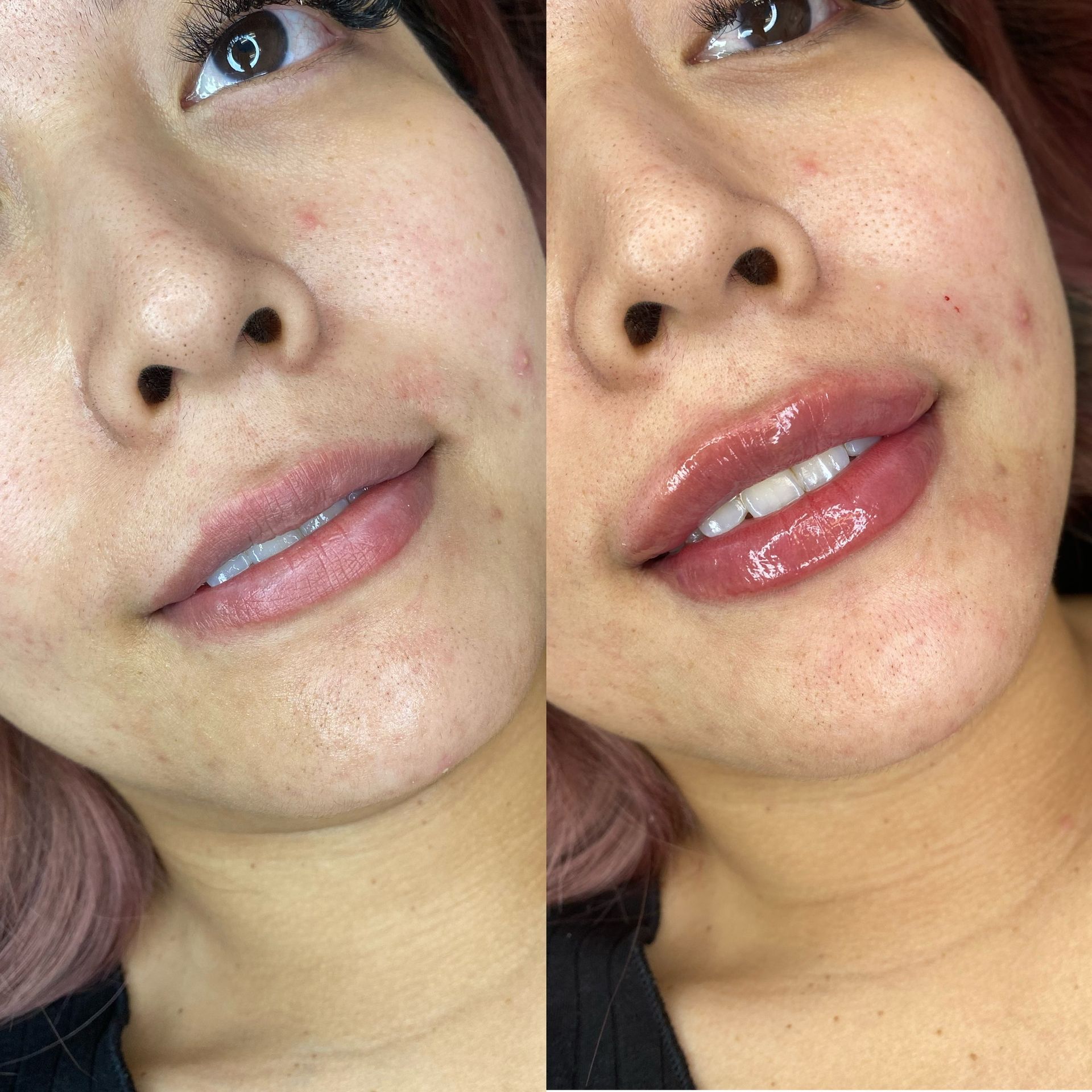 Injectables Lip Filler in Boston and Southborough MA