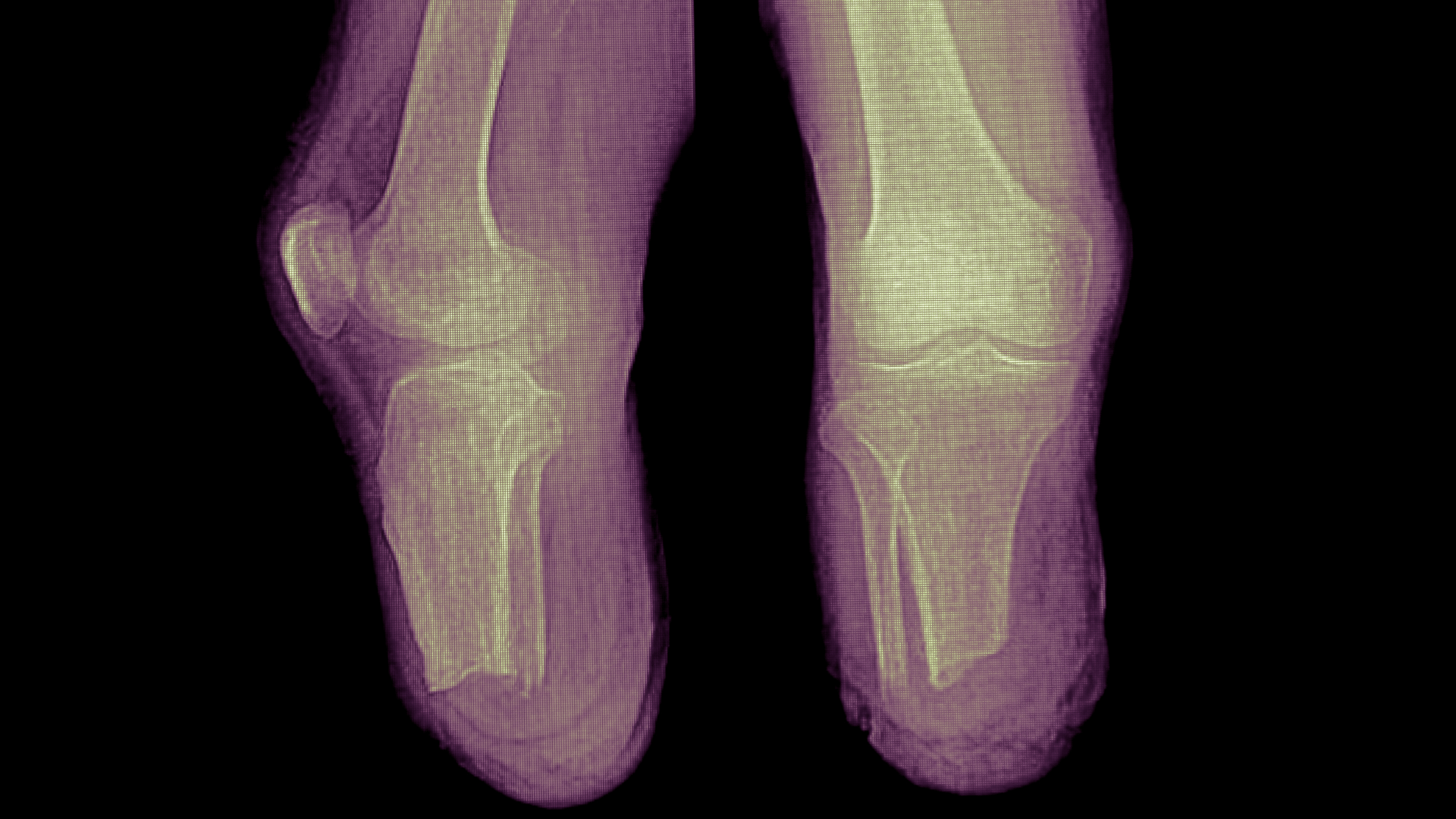 O que é neuroma de amputação?