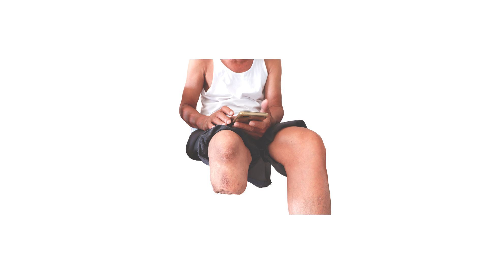 O que é Amputação Transtibial?