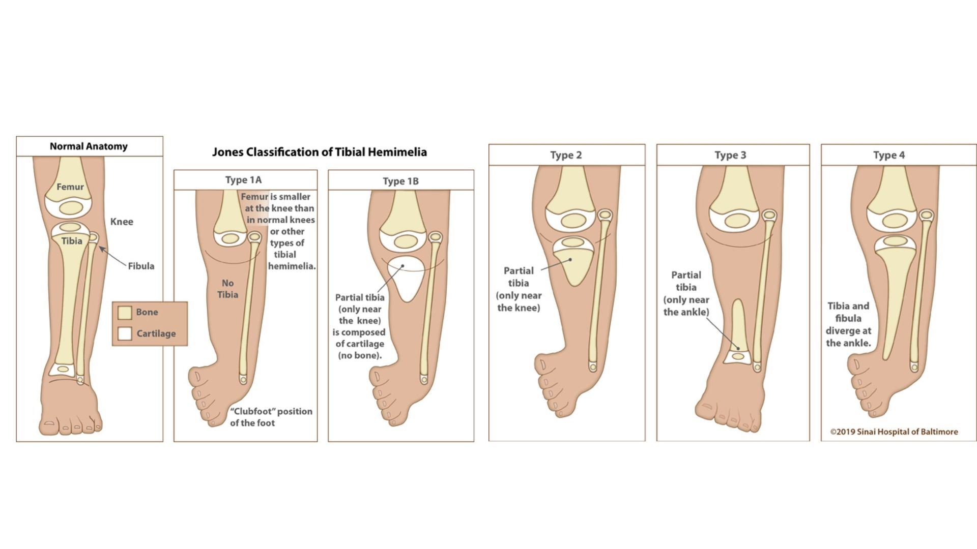 Hemimelia Fibular: Entendendo esta Condição Congênita Rara