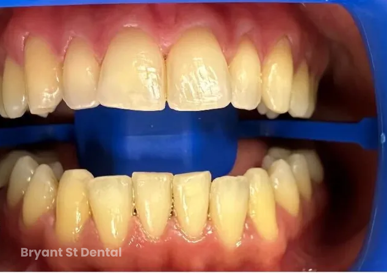 Best Dentist in Palo Alto | Dentistry | Bryant St Dental